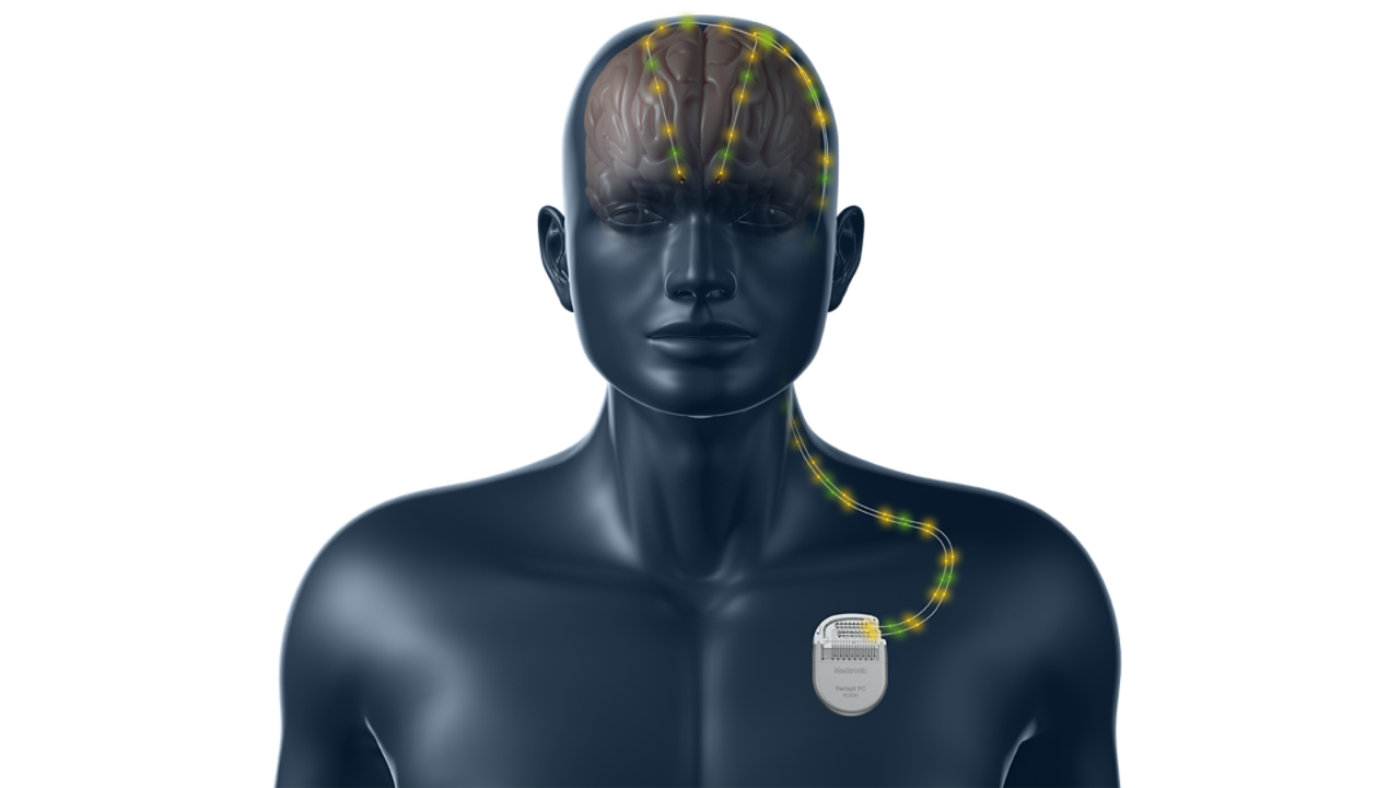 Trattare il Parkinson con ‘pacemaker’ cerebrali: tra entusiasmo dei ...